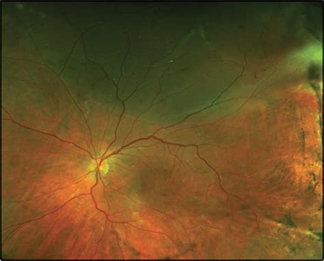 Management Of Concurrent And Delayed Onset Retinal Detachment Associated With Endophthalmitis