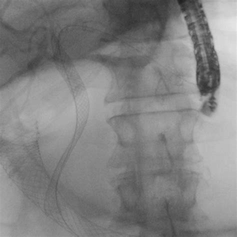 Eus Guided Drainage A Direct Endoscopic Necrosectomy Carried Out B