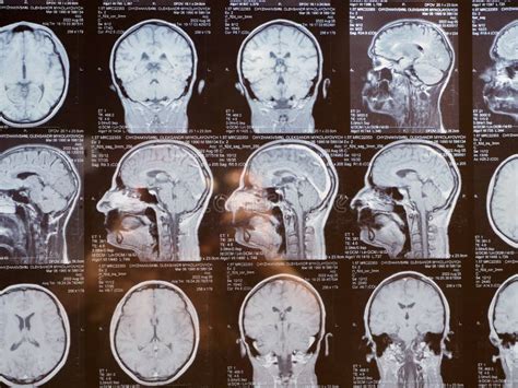 Mri Human Brain With Multiple Sclerosis Stock Image Image Of Medical