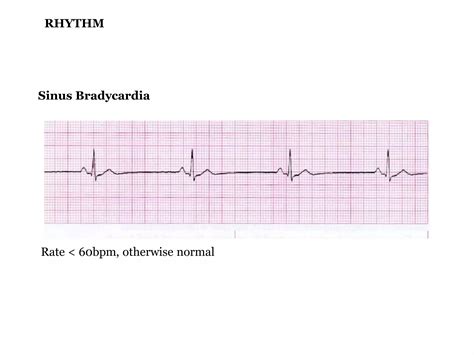 Basic Ecg Ppt