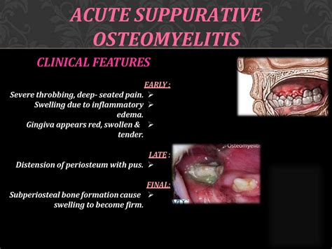 Pathogenesis And Management Ppt Download