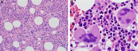 Megakaryocyte Clusters And Atypical Morphology Left Megakaryocyte