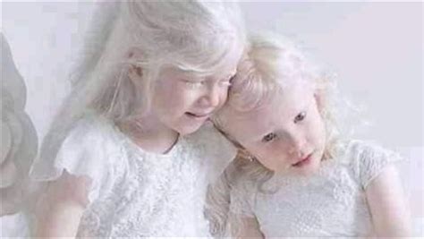 من هم الألبينو أو أعداء الشمس؟