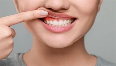 How To Treat A Hard Bony Lump On Gum At Home Grove Dental Clinic
