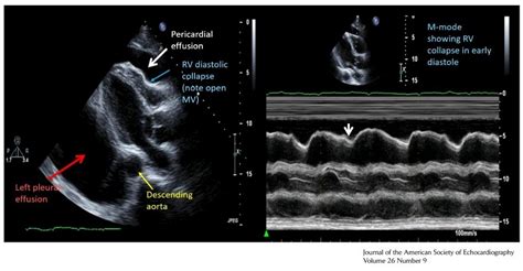Dr Omer Kutubi On Linkedin Rv Diastolic Collapse Amazing Illustration