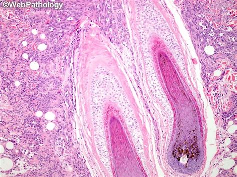 Cutaneous Angiosarcoma