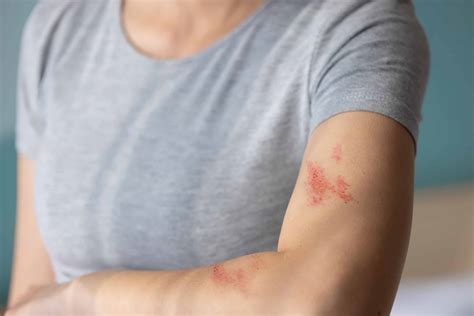 Shingles Lifescan Medical And Wellness