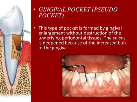 Periodontal Pocket Images At Stefanie Norton Blog