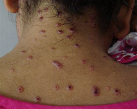 Cryptococcus Neoformans Meningitis