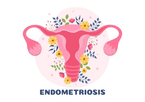 Endometriosis With Condition The Endometrium Grows Outside The Uterine