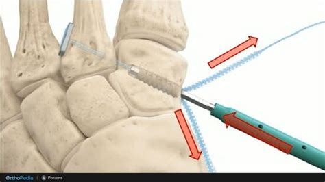 Lisfranc Injuries—why Fuse When You Can Fix Part 4 Lisfranc Internalbrace™ Ligament