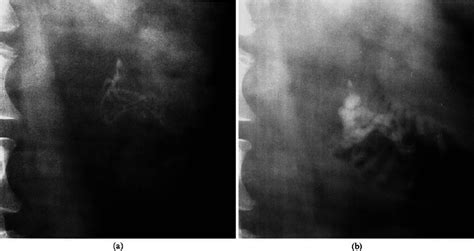 Atypical Linear Calcification Within The Left Renal Pelvis A Which Download Scientific