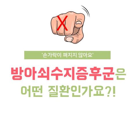 조은마디병원이 알려드리는 질환상식 방아쇠수지증후군 건강정보 조은마디병원