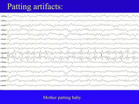Artifacts In Eeg Final Ppt Brain And Nervous System Disorders Diseases And Conditions