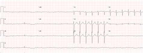 Differential Diagnosis Of Low Voltage ECG