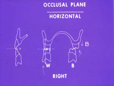 The Arrangement Of Posterior Anatomic Teeth Flashcards Quizlet