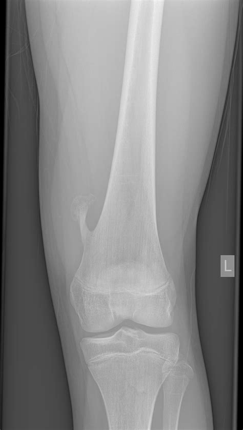 Osteochondroma Distal Femur Image