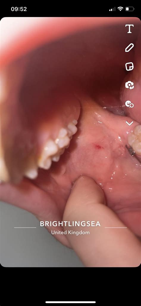 Does Anyone Think This Is Mouth Cancer The Patches On The Roof Of