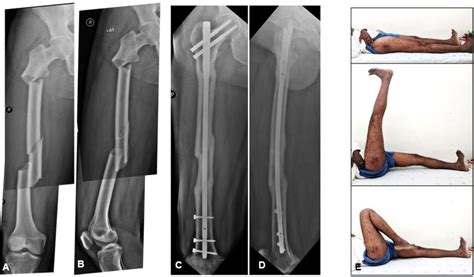 Representative Radiographs Of Double Segmental Femur Shaft Fracture In Download Scientific