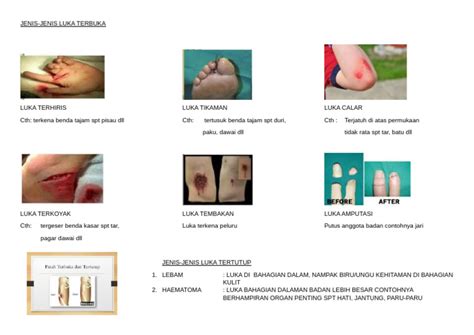 Jenis Jenis Luka Pdf