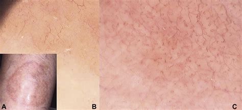 Dermatoscopy Of Early Onset Necrobiosis Lipoidica Journal Of The