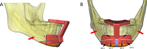 Figure 1 From A New Design Of CAD CAM Surgical Template System For Two