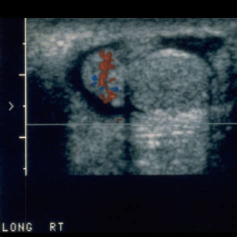 Pediatric Epididimo Orchitis Pediatric Radiology Reference Article