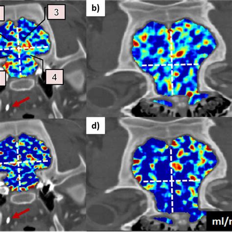 Perfusion Color Maps Generated By The Two Volume Ct Perfusion Technique Download Scientific