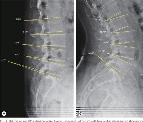 Flexion And Extension Spine