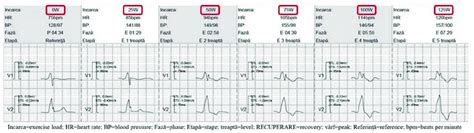 During Exercise A Lengthening Of Pr Interval Leads To Complete Lv Download Scientific Diagram