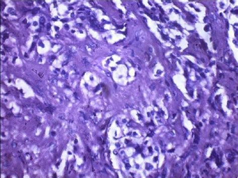 Figure 1 From T2 Breast Cancer Presenting With Diffuse Liver Metastases And Hepatic Failure Figure 1 From T2 Breast Cancer Presenting With Diffuse Liver Metastases And Hepatic Failure