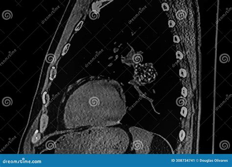 Lateral View Of Chest Cat Scan That Shows Popcorn Calcification A Hamartoma Tumor On The Left
