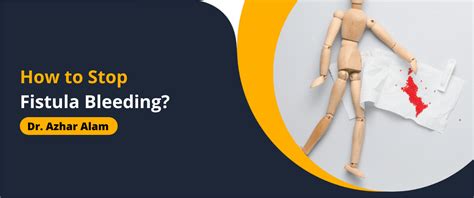 How To Stop Fistula Bleeding By Dr Azhar Alam