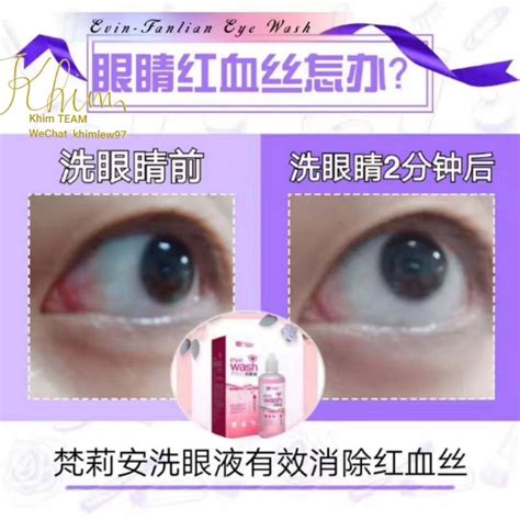 ── 轻松解决红血丝问题 Fanlian Eye Wash 梵莉安洗眼液