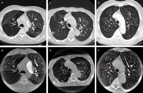 Patterns Of Mosaic Perfusion On Ct And Cact A B Pattern 1 Sharply Download Scientific
