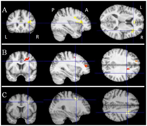 Results Of The Voxel Based Morphometric Vbm Analysis Correlations