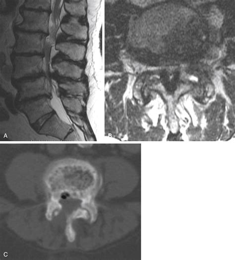 Posterior Approaches To The Lumbar Spine Minimally Invasive Decompression Clinical Tree
