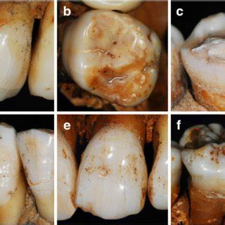Exemplary Tooth Surfaces With Different Types Of Enamel Disorders