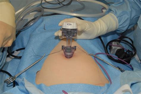 Open Laparoscopy GLOWM