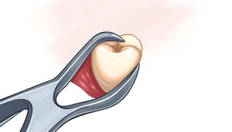 Third Molar Extraction Guidelines And Innovations