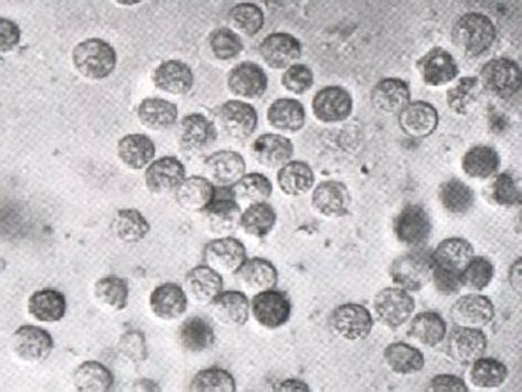 Ideas De Sedimento Urinario Urinarios Sedimentarias Eritrocitos