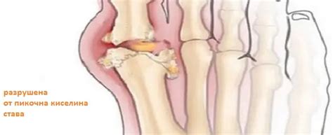 Бързо сваляне на пикочна киселина Билкови таблетки Гутрол Фебуксостат Подагрол Тема 21