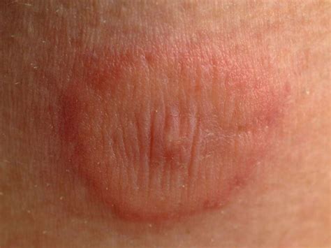 Bursitis 10 Symptoms Of Bursitis