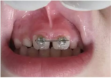 【小白兔口腔科普】12岁前必须处理的20种儿童牙颌畸形关爱儿牙陕西嘉友科贸有限公司