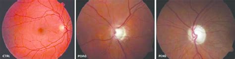 Sample Fundus Photographs From Three Patients Included In The Study