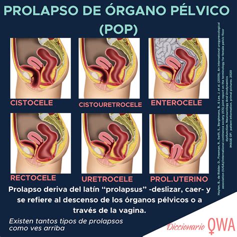 Prolapso De órgano Pélvico Pop