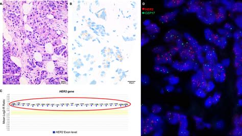 Her2 Amplification By Ngs In A Breast Carcinoma With A Negative Her2