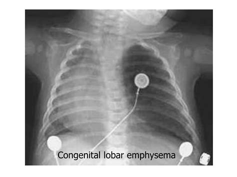 PPT THE TERM NEONATE WITH RESPIRATORY DISTRESS PowerPoint Presentation ID