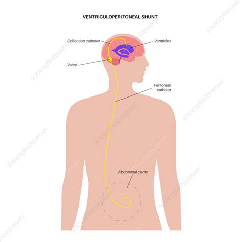 Ventriculoperitoneal Shunt Illustration Stock Image F036 3955