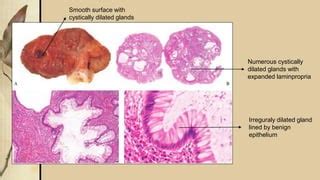 Gi Polyps Pdf